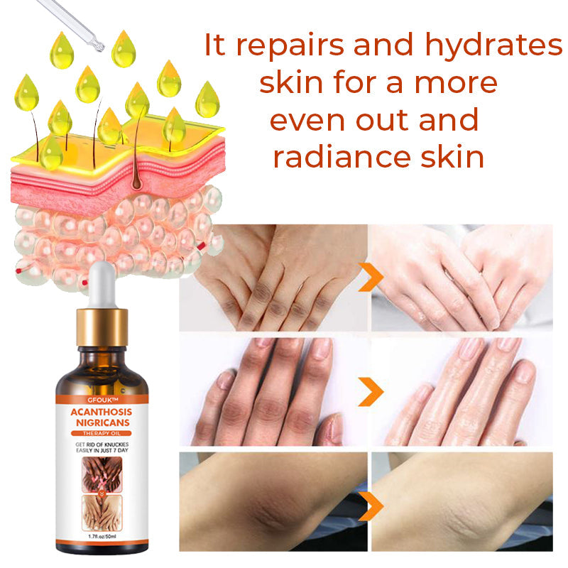 GFOUK™ Acanthosis Nigricans Therapy Oil – G-FOUK