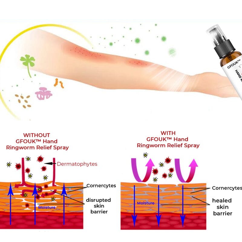 GFOUK™ Hand Ringworm Relief Spray – G-FOUK